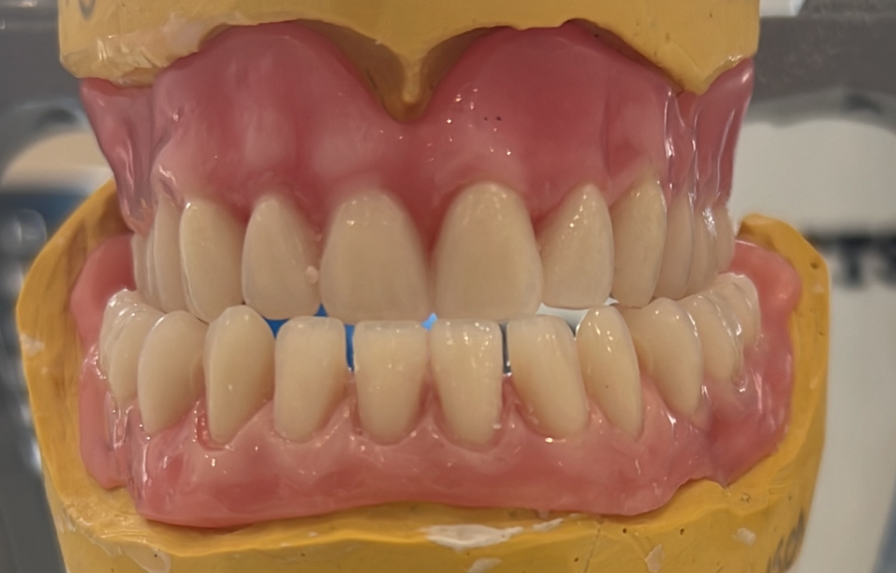 Our Denture Services – Echo Dental Solutions